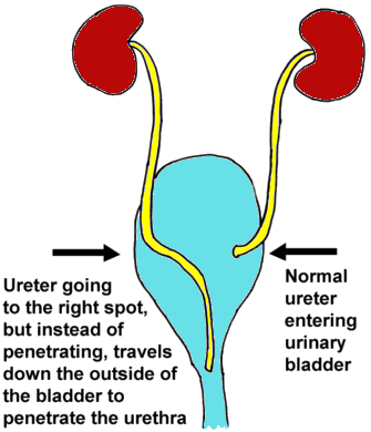 Ectopic Ureter